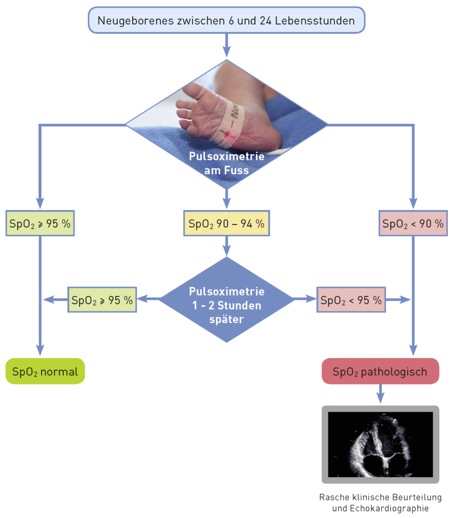 Pulsoximetrie Screening zur Erfassung von kritischen angeborenen ...