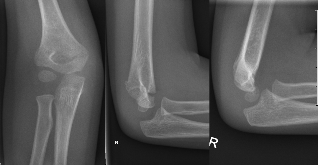Frakturbehandlung - ein Leitfaden für die Praxis - pädiatrie schweiz