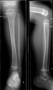 Traitement des fractures – un guide pratique - pädiatrie schweiz