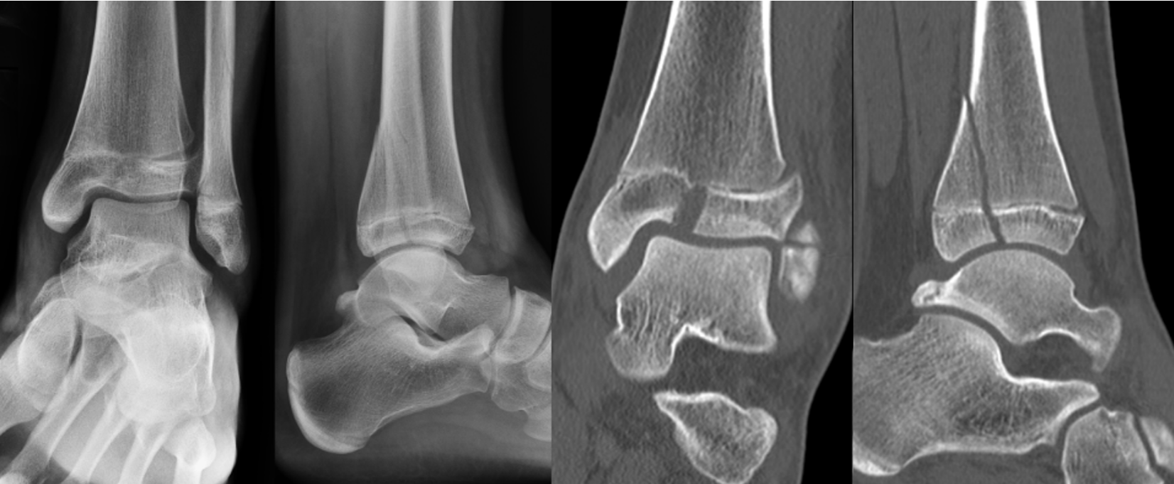 Frakturbehandlung - ein Leitfaden für die Praxis - pädiatrie schweiz