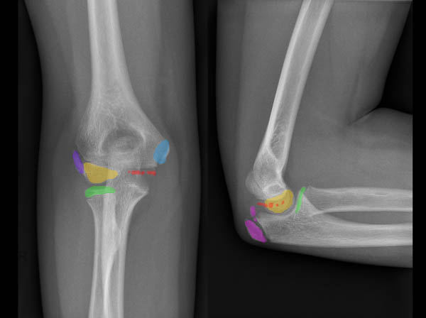 Traitement des fractures – un guide pratique - pädiatrie schweiz