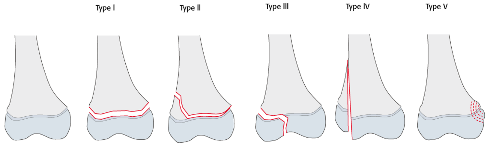 Traitement des fractures – un guide pratique - pädiatrie schweiz