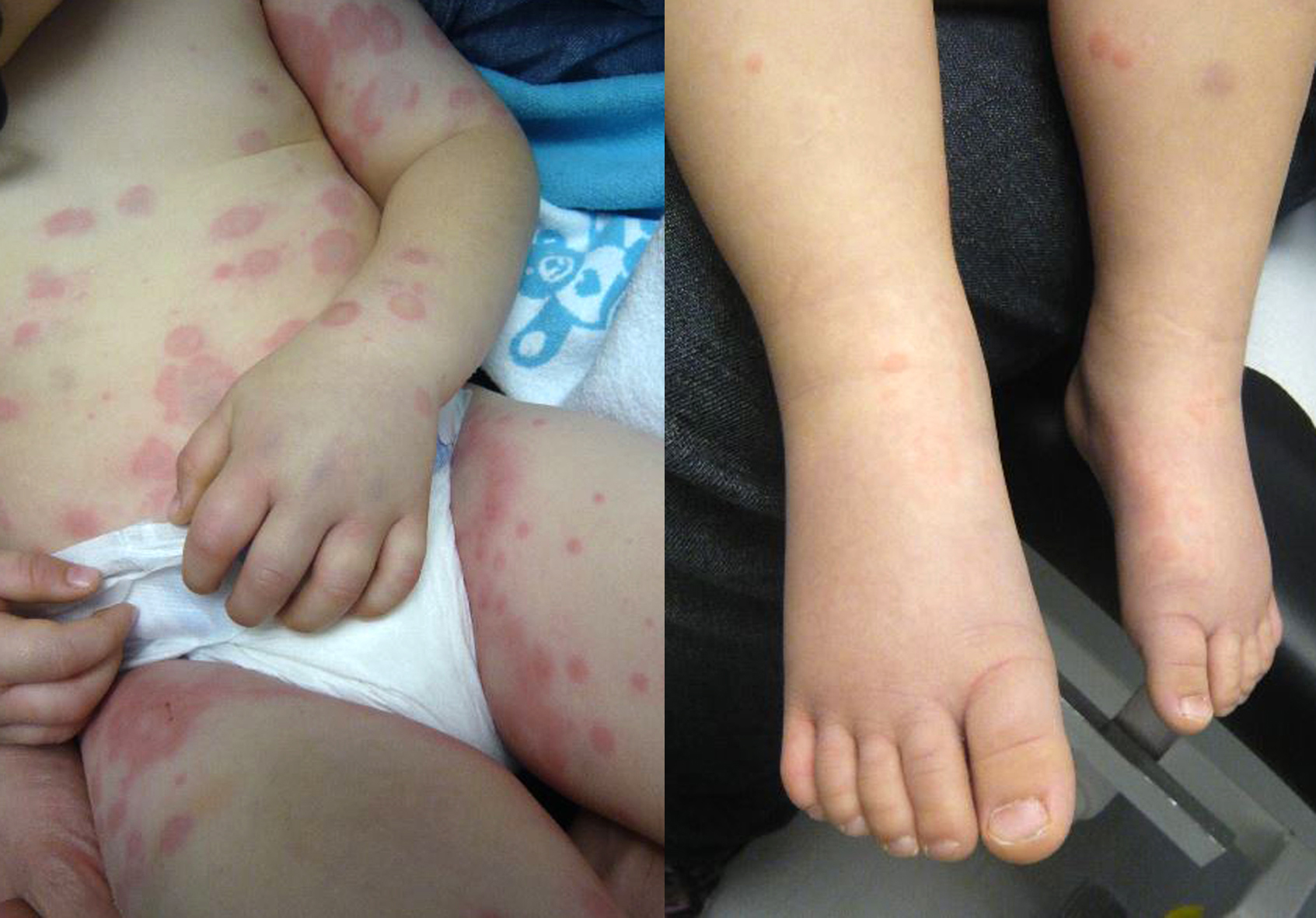 MALADIES DERMATOLOGIQUES AIGUËS DE L’ENFANT - pädiatrie schweiz