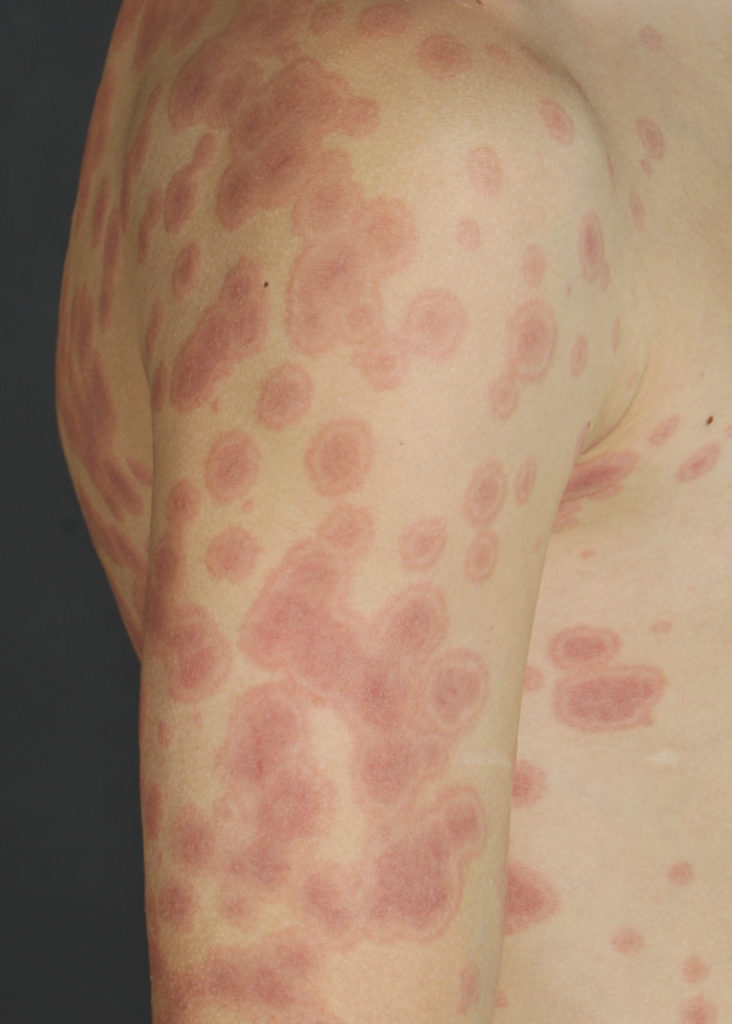 MALADIES DERMATOLOGIQUES AIGUËS DE L’ENFANT - pädiatrie schweiz