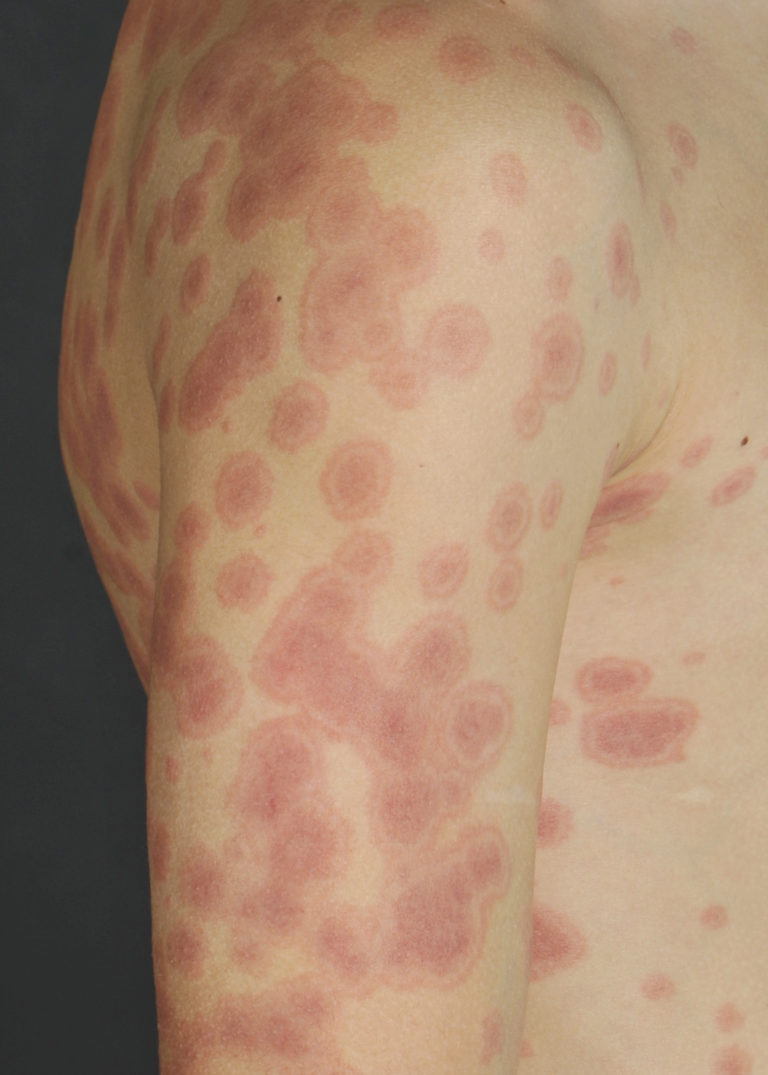 MALADIES DERMATOLOGIQUES AIGUËS DE L’ENFANT - pädiatrie schweiz