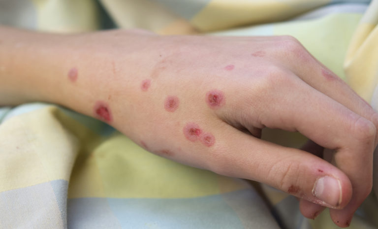 MALADIES DERMATOLOGIQUES AIGUËS DE L’ENFANT - pädiatrie schweiz