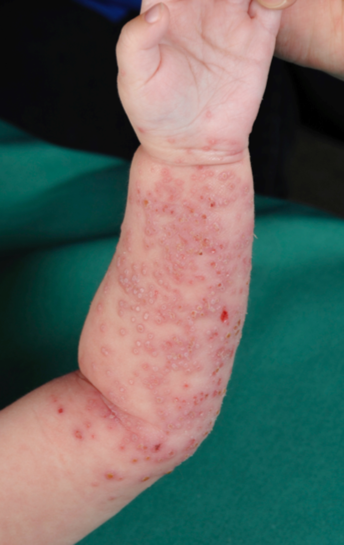 MALADIES DERMATOLOGIQUES AIGUËS DE L’ENFANT - pädiatrie schweiz