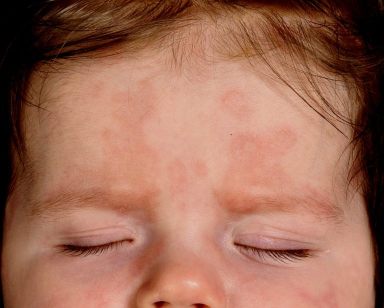 QUAND ÇA DÉPASSE LA PEAU – SIGNES CUTANÉS ÉVOQUANT UNE MALADIE ...