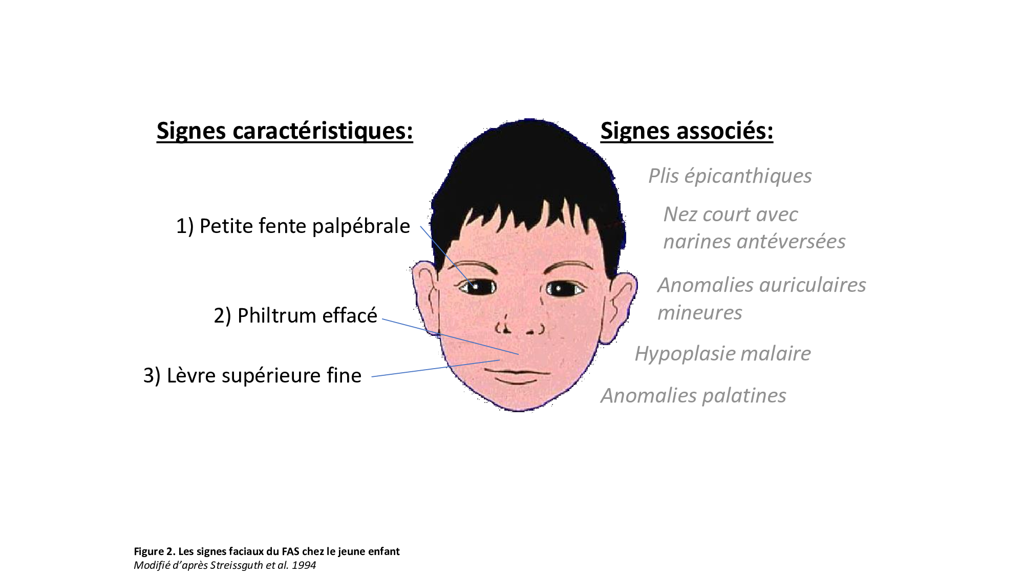 Le Syndrome foeto-alcoolique - pädiatrie schweiz