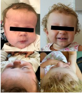 Endoskopisch assistierte Kraniosynostose-Operation - pädiatrie schweiz