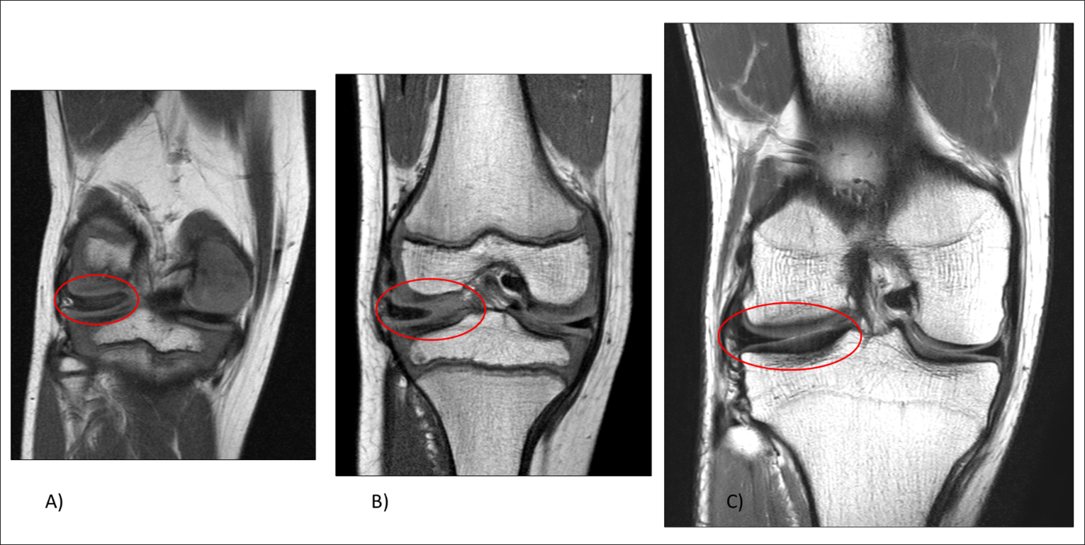 Der Laterale Scheibenmeniskus - pädiatrie schweiz