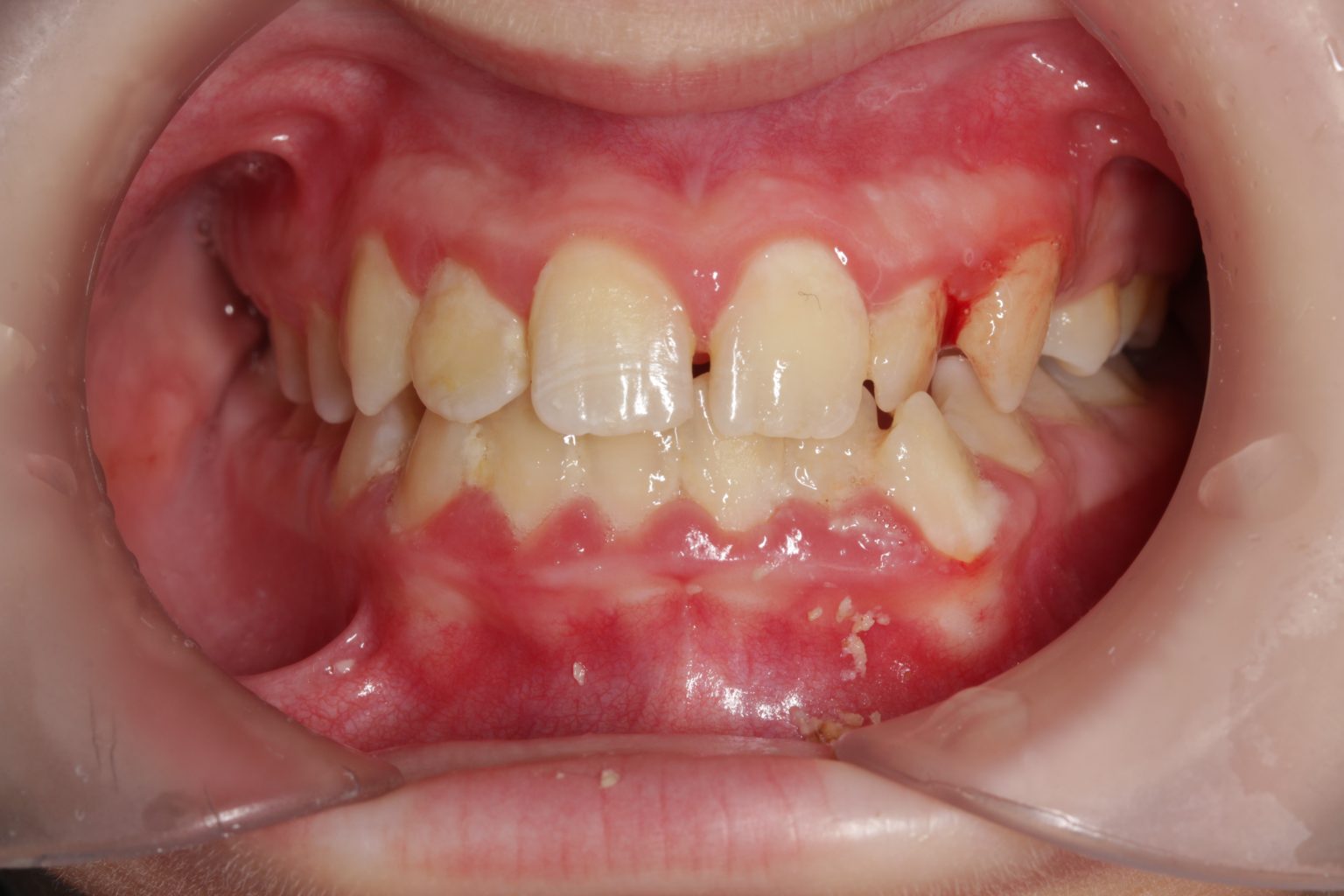 Update Endokarditis - pädiatrie schweiz