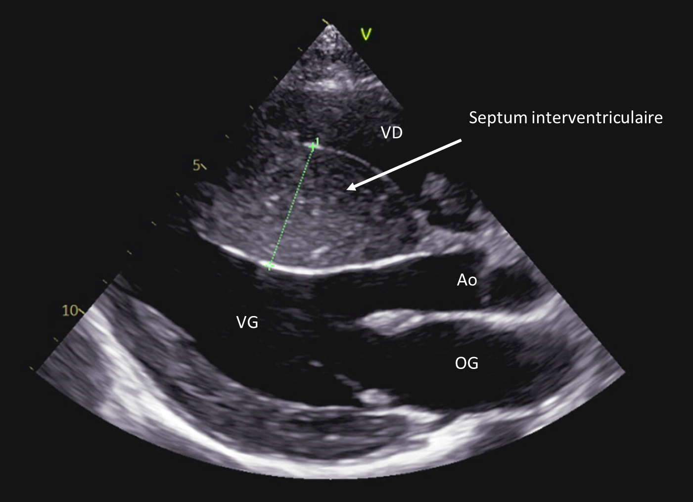 Cardiogénétique - update - pädiatrie schweiz