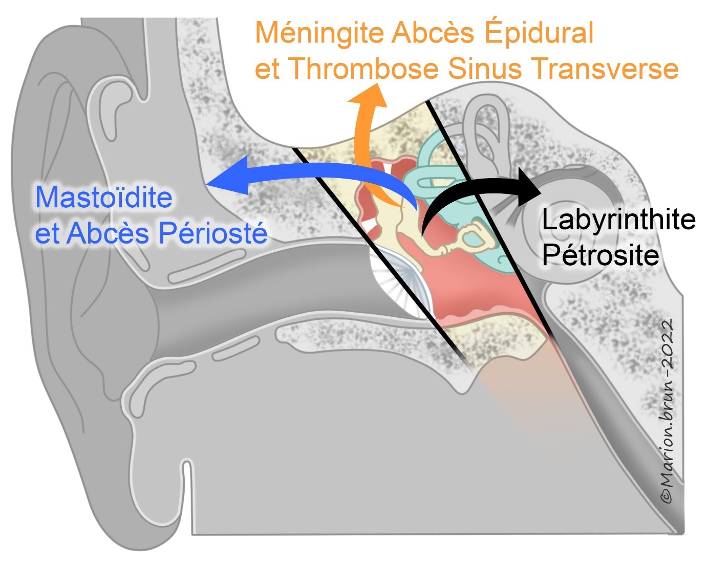 Otite moyenne aiguë – prise en charge moderne - pädiatrie schweiz