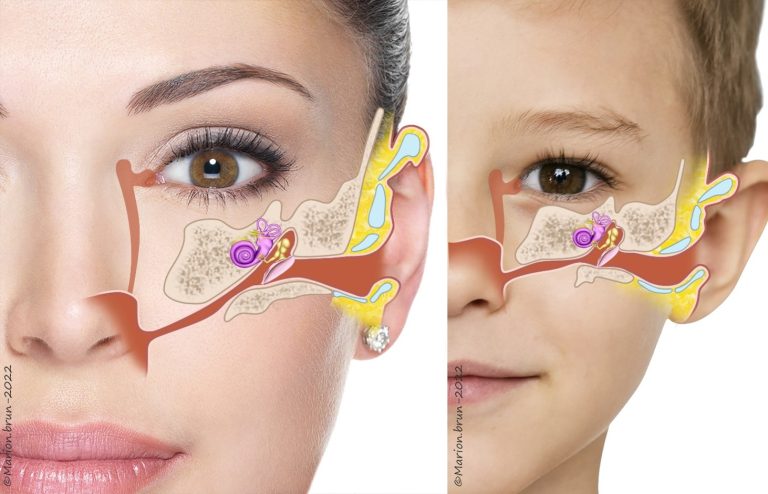 Otite moyenne aiguë – prise en charge moderne - pädiatrie schweiz