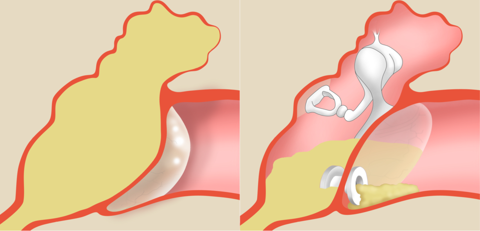 Otite moyenne aiguë – prise en charge moderne - pädiatrie schweiz