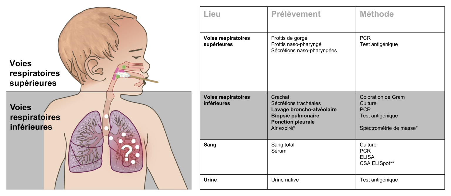 Diagnostic et traitement de la pneumonie pendant l’enfance et l ...