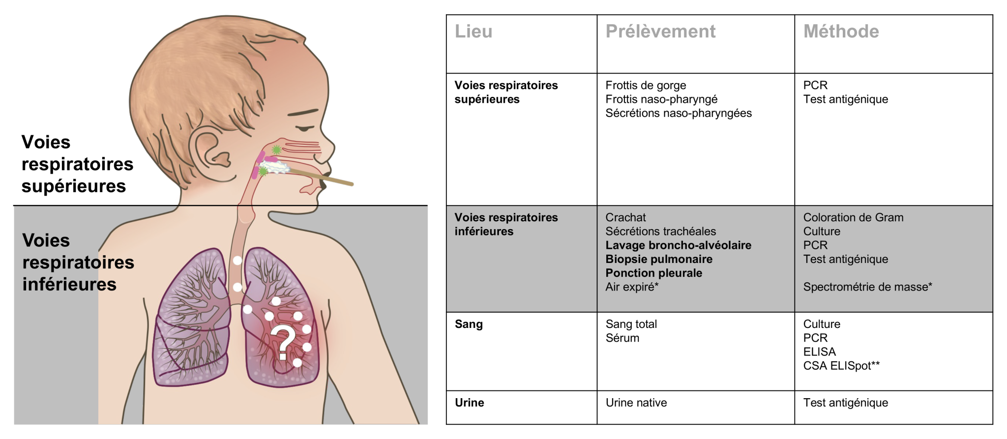Diagnostic et traitement de la pneumonie pendant l’enfance et l ...