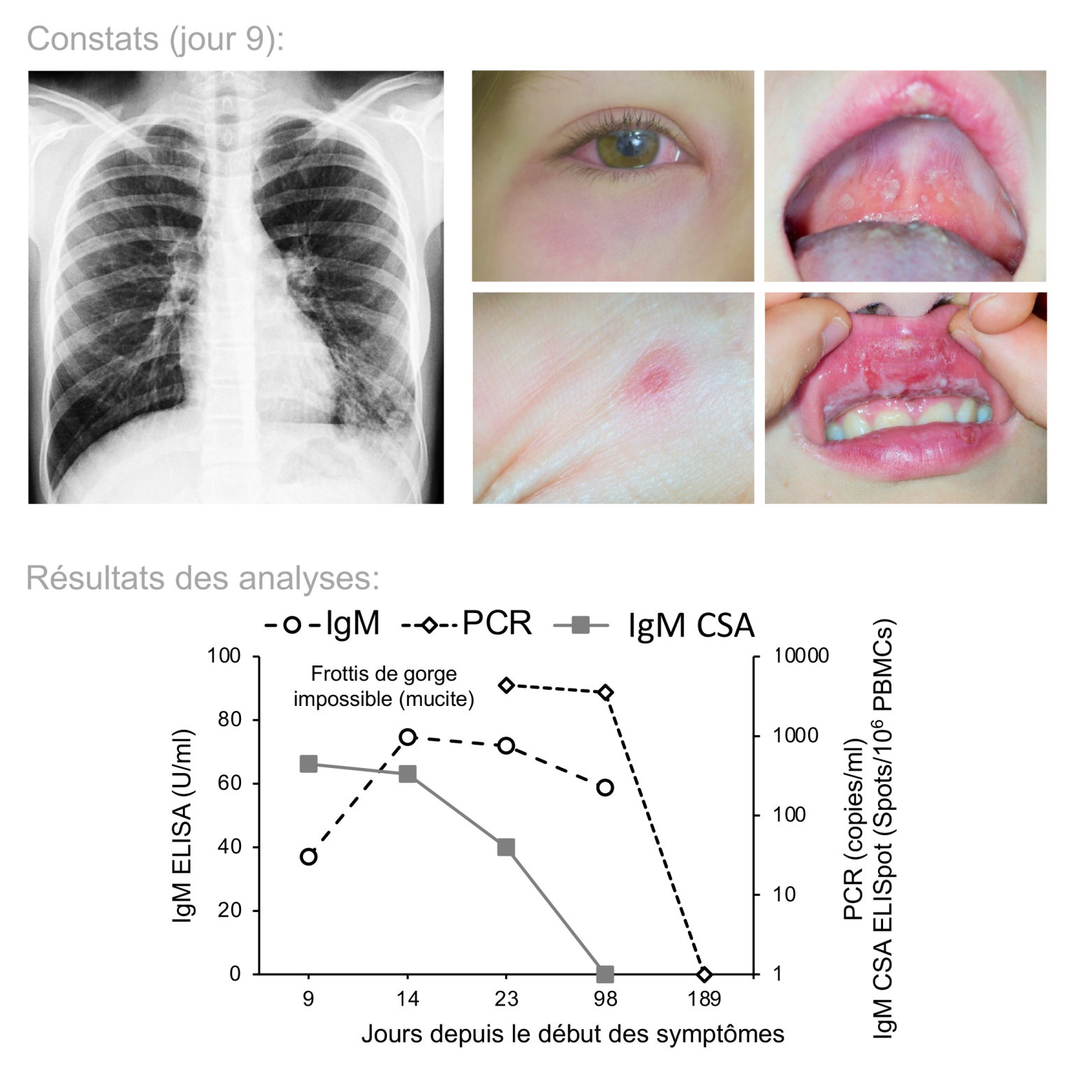 Diagnostic et traitement de la pneumonie pendant l’enfance et l ...