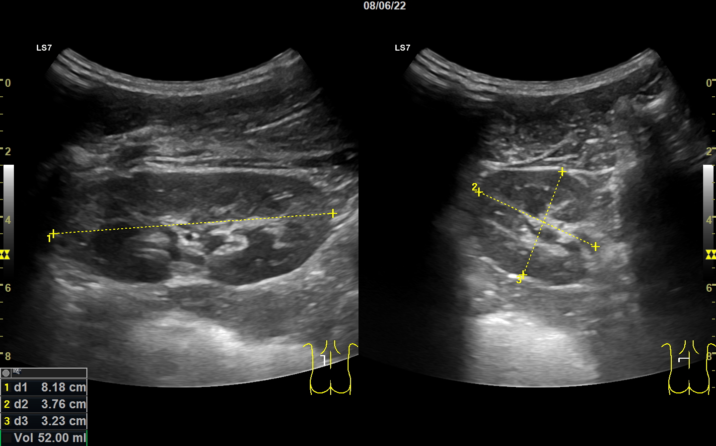 Ultraschall zur Diagnostik der akuten Harnwegsinfektion bei Kindern ...