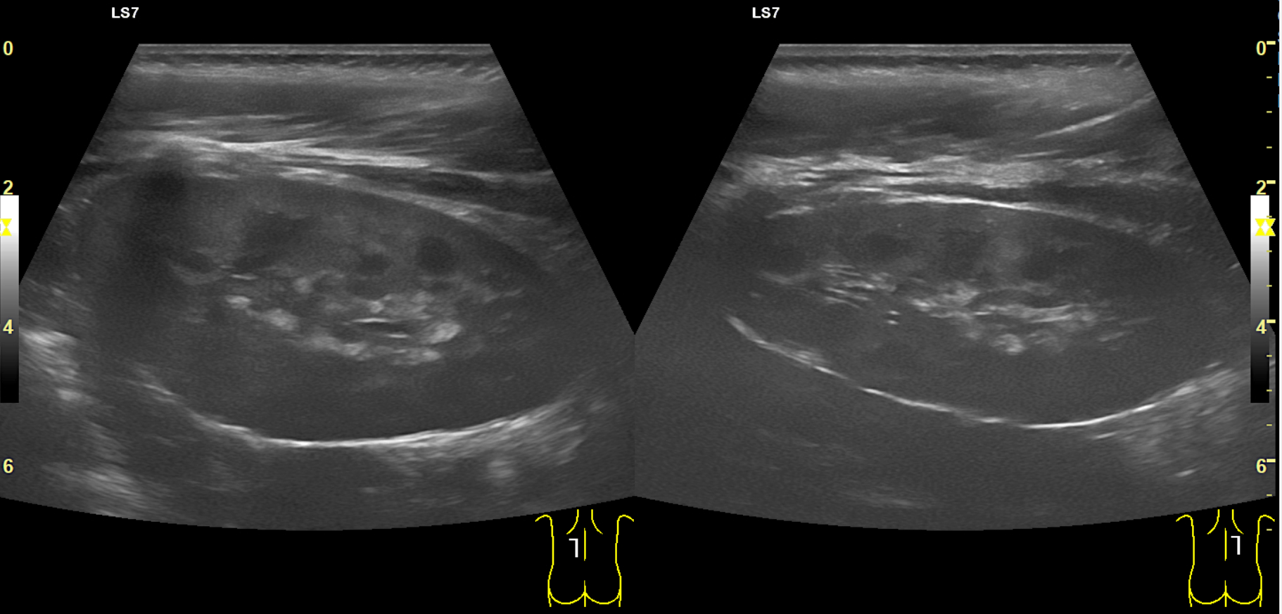 Ultraschall zur Diagnostik der akuten Harnwegsinfektion bei Kindern ...