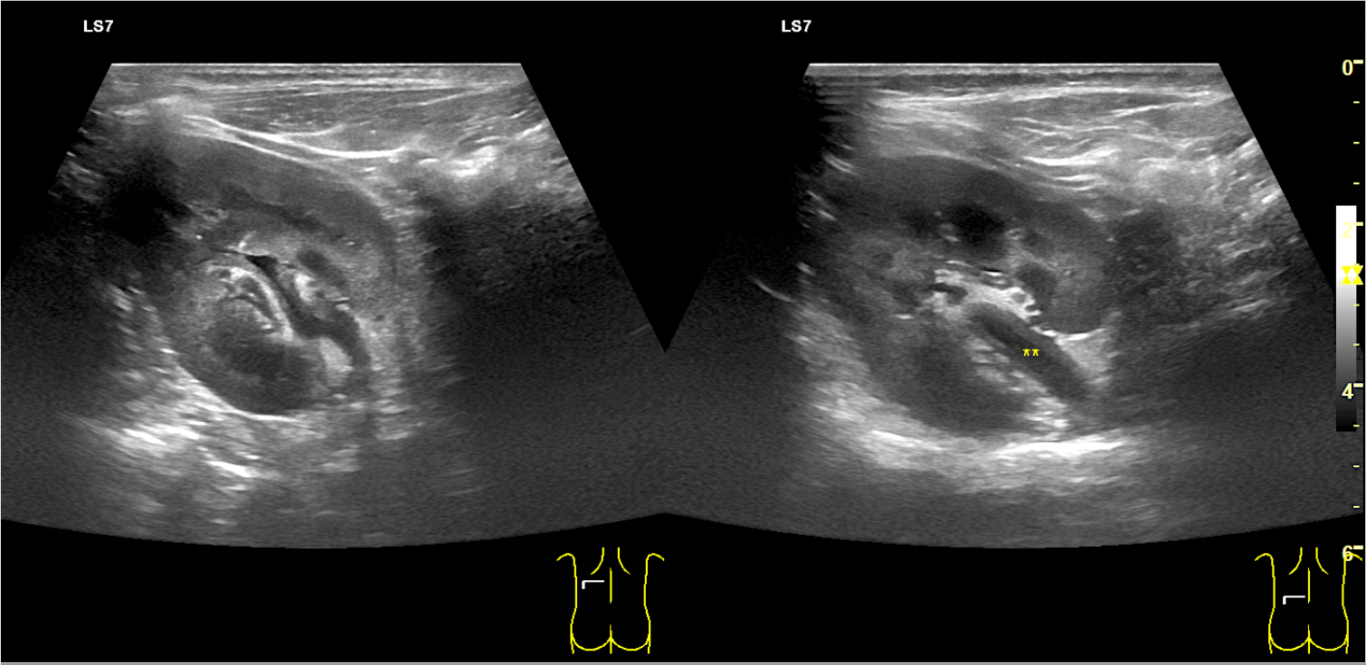 Ultraschall zur Diagnostik der akuten Harnwegsinfektion bei Kindern ...