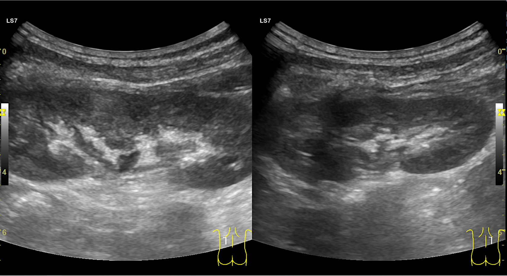 Ultraschall zur Diagnostik der akuten Harnwegsinfektion bei Kindern ...