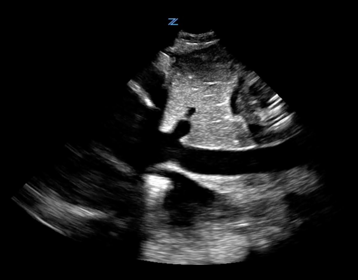 Utilité du POCUS pour évaluer l’état de choc en pédiatrie - pädiatrie ...