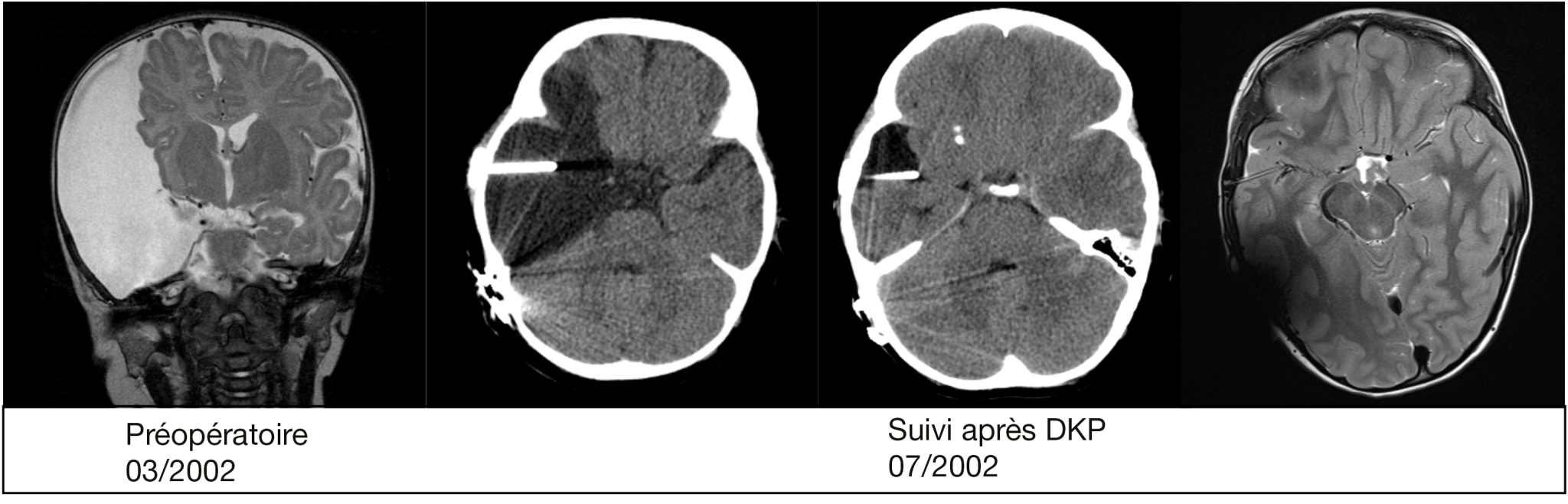 Traitement des kystes arachnoïdiens intracrâniens de l’enfant ...