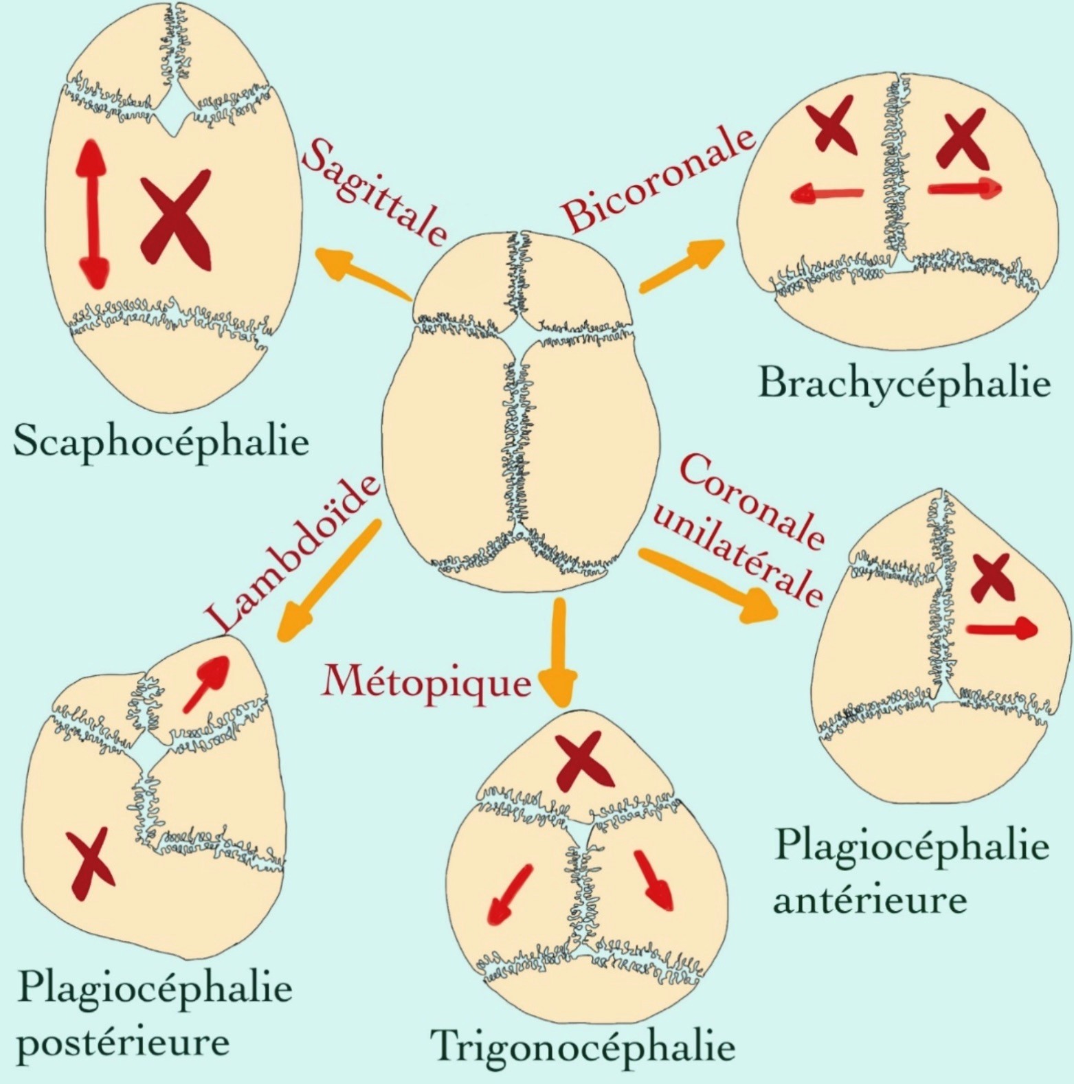 Craniosténoses : malformations congénitales avec un traitement ...