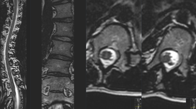 Klinische und radiologische Untersuchung der idiopathischen Skoliose ...