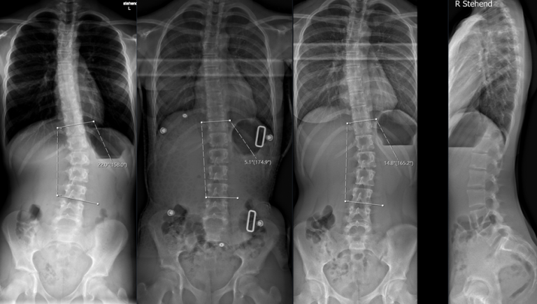 Examen clinique et radiologique de la scoliose idiopathique - pädiatrie ...