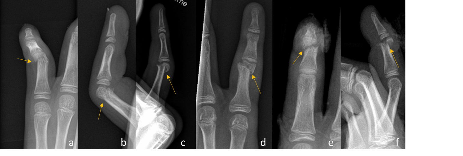 Häufige traumatische Handverletzungen bei Kindern und Jugendlichen ...