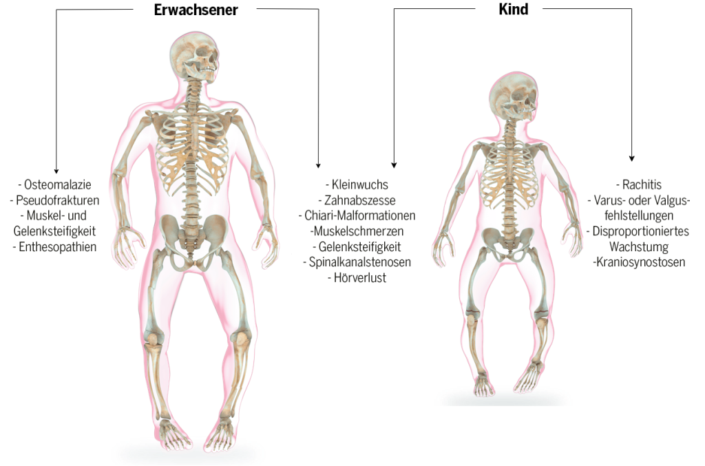 X-chromosomale Hypophosphatämie (XLH): Ein Update zum ...